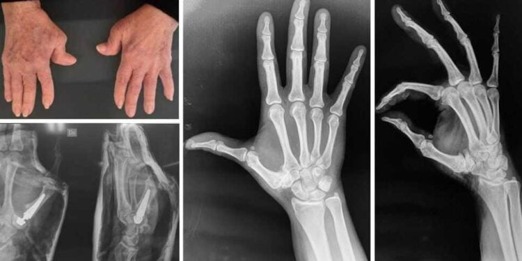 Protesi articolare per pazienti con artrosi del pollice al Policlinico ...